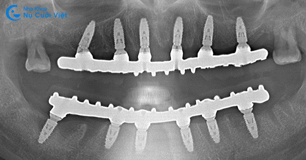 Trồng răng Implant All On 6 là gì? Chi phí trọn gói như thế nào?